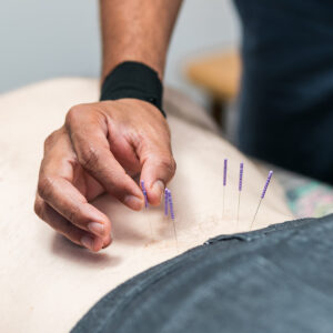 Dry Needling Werribee - Wyndham Physio & Rehab